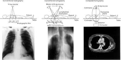 RADIOGRAPHY 2009: LINEAR TOMOGRAPHY